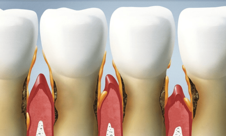 How To Slow Down Bone Loss In Teeth | Soft Touch Dental